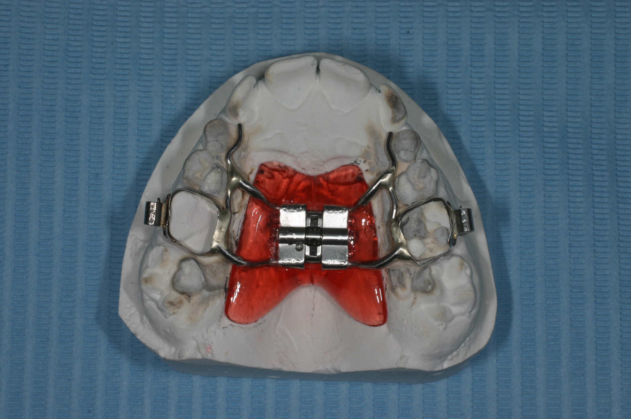 Espansore palatale fisso o mobile?